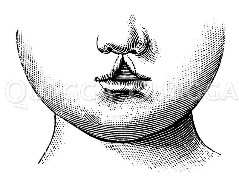 Hasenscharte (Gespaltene Lippe)